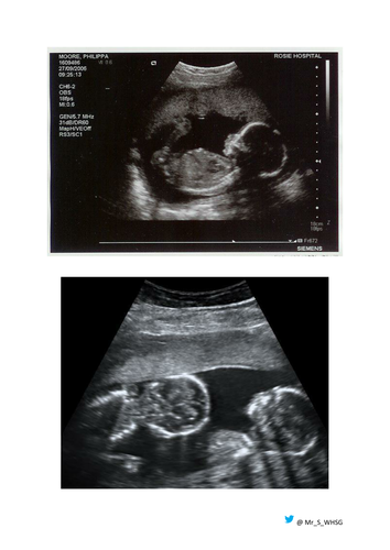 Variety of baby scan images for twins and reproduction | Teaching Resources