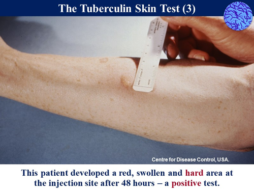 BioA_4.1.1 Pathogens - Tuberculosis (TB) | Teaching Resources