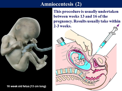 Bio5.g Foetal Screening & Counselling (Fetal Screening) | Teaching ...