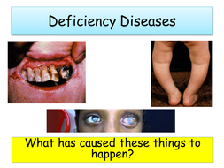 Deficiency Diseases | Teaching Resources