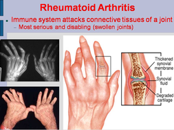 Joints & Pathology of the Skeletal System PowerPoint & Worksheet ...