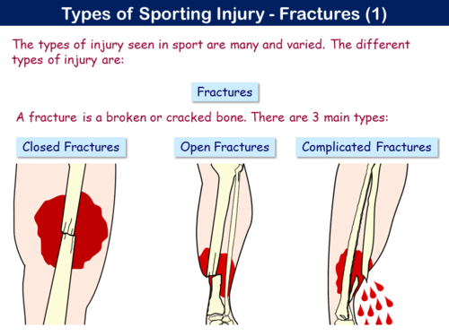 PE706ST - Types of Injury by RGeorge15 - Teaching Resources - TES