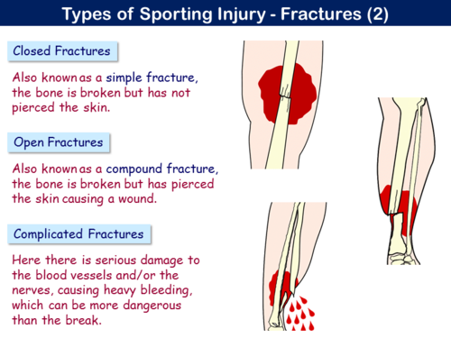 PE706ST - Types of Injury | Teaching Resources
