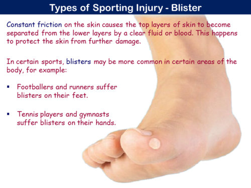 PE706ST - Types of Injury | Teaching Resources