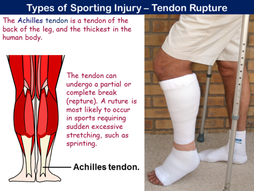 PE706ST - Types of Injury | Teaching Resources