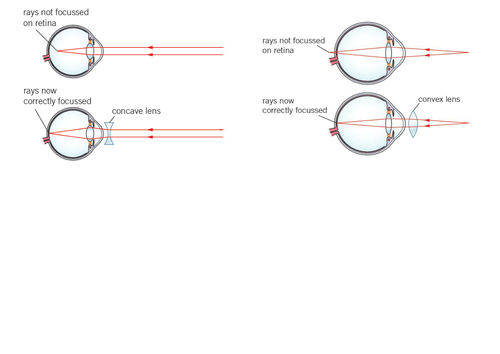 B10.5 B10.6 The eye and complications | Teaching Resources