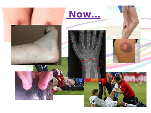 Cambridge National Sports Science Injury Revision Activities | Teaching ...