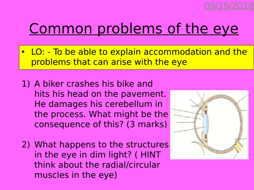 B10.6 Common problems of the eye (AQA) | Teaching Resources
