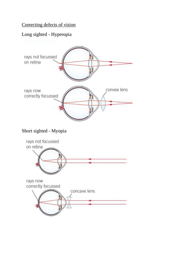 AQA GCSE Biology (9-1) B10.6 Common problems of the eye FULL LESSON ...