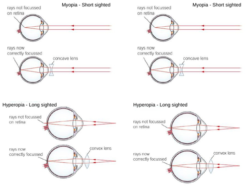 AQA GCSE Biology (9-1) B10.6 Common problems of the eye FULL LESSON ...