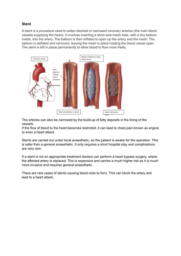 Treating cardiovascular disease (GCSE) | Teaching Resources
