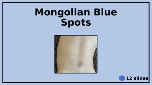 Mongolian Blue Spots - Congenital dermal melanocytosis - Bruises or not ...