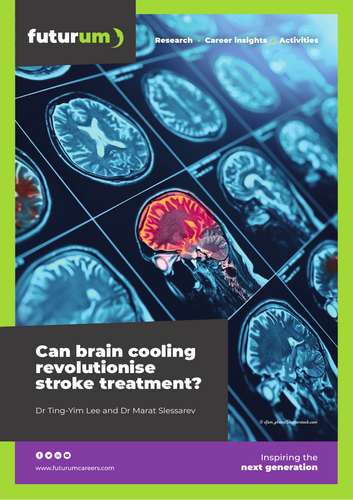 Can brain cooling revolutionise stroke treatment? | Teaching Resources