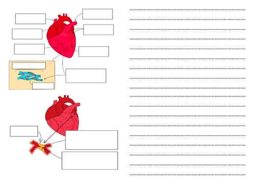 **iGCSE Biology Edexcel - CORONARY HEART DISEASE** | Teaching Resources