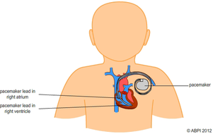 Artificial Pacemaker | Teaching Resources