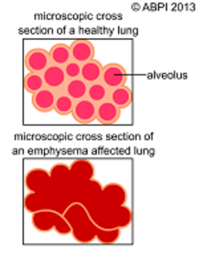 Emphysema & Alveoli | Teaching Resources